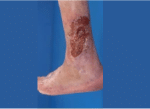 Felty Syndrome in Long-Standing Rheumatoid Arthritis - medtigo Journal