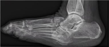 Charcot Arthropathy in Diabetic Patients: A Case Study - medtigo Journal