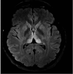 Creutzfeldt-Jakob Disease: A Case Report and Review - medtigo Journal