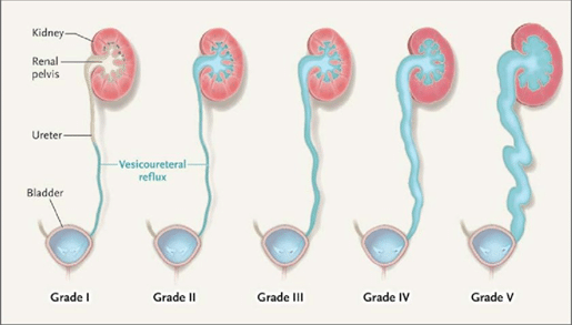 Pediatric Vesico-Ureteral Reflexes: Current Management - medtigo Journal
