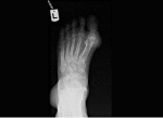 Martel's Sign in Chronic Gout - medtigo Journal