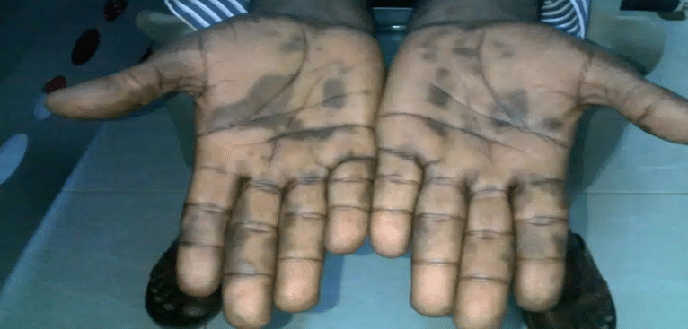 A Middle-Aged Adult with Persistent Fatigue and Hyperpigmentation ...