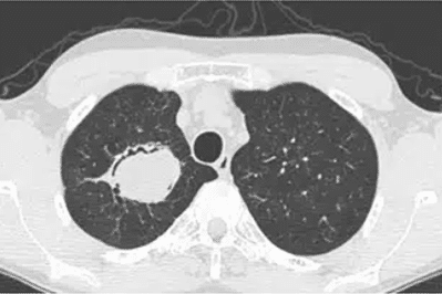 How Rare is Chronic Pulmonary Aspergillosis - medtigo Journal