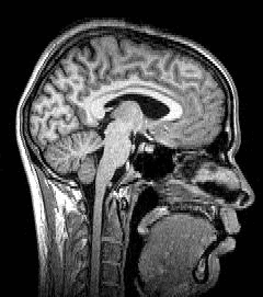 Cognitive Changes and CSVD: A Case Study with MRI Findings - medtigo ...