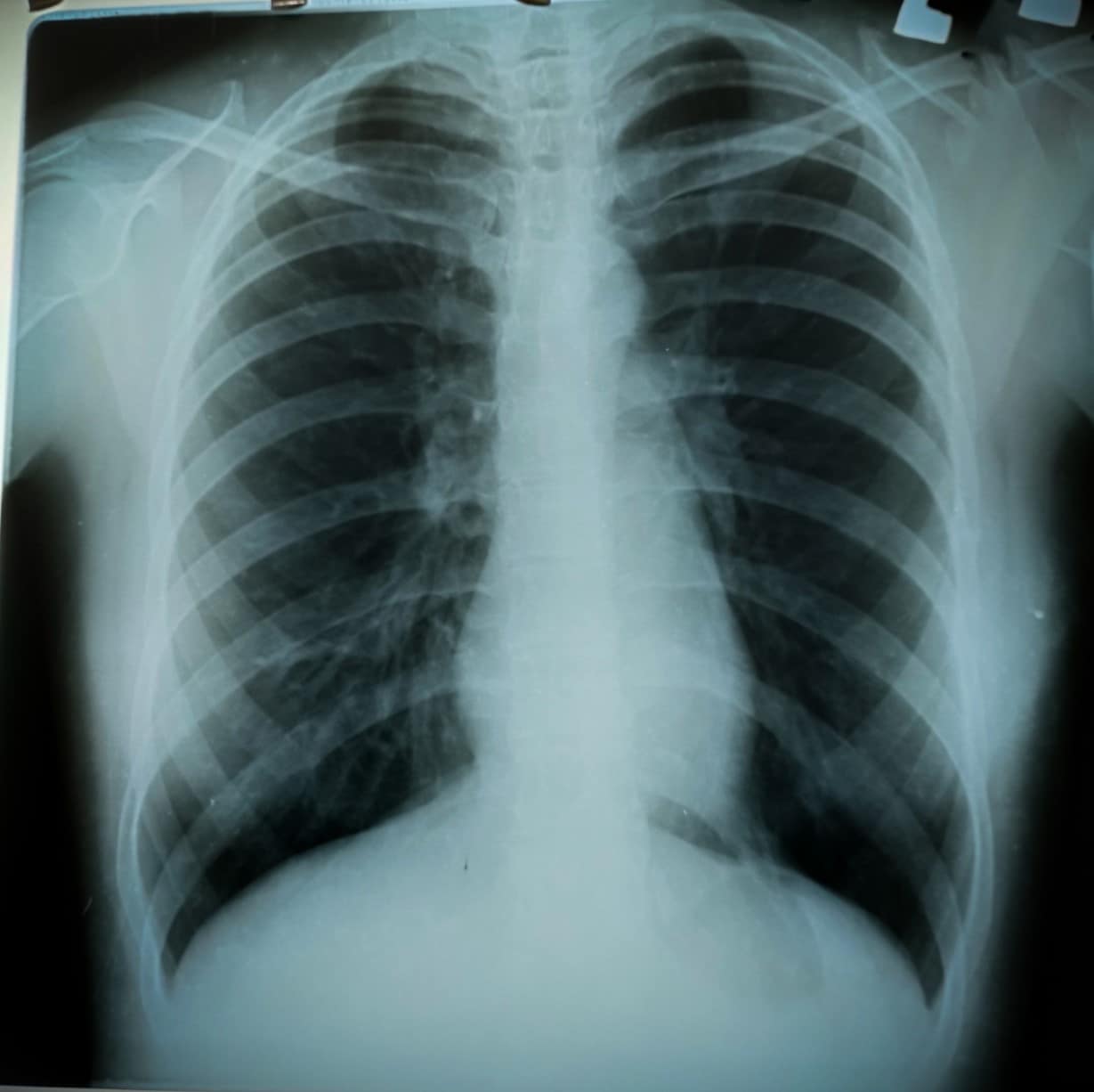 Clinical Pearl: Workup of Left-Sided Chest Pain in a COPD Patient ...