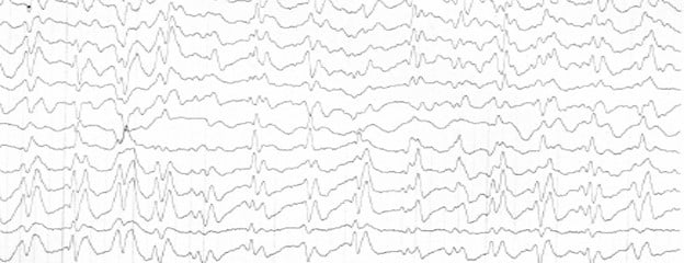 Visual Signs Reveal Heidenhain Variant of CJD in Rare Case - medtigo ...