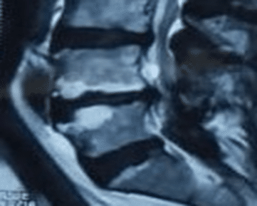 PRP Injections for Low Back Pain: Effective Modic I Solution - medtigo ...