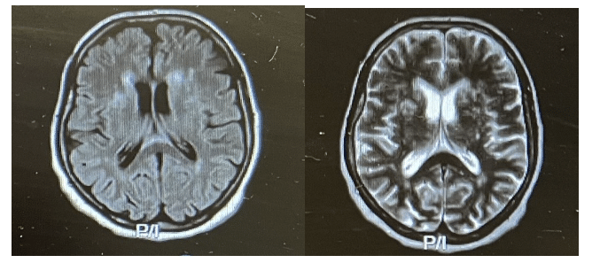 Visual Signs Reveal Heidenhain Variant of CJD in Rare Case - medtigo ...