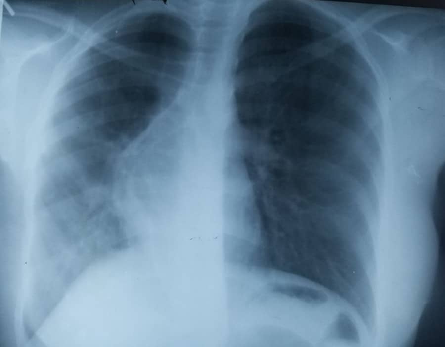 Scimitar Syndrome Misdiagnosed: Lessons from a Rare Case - medtigo Journal