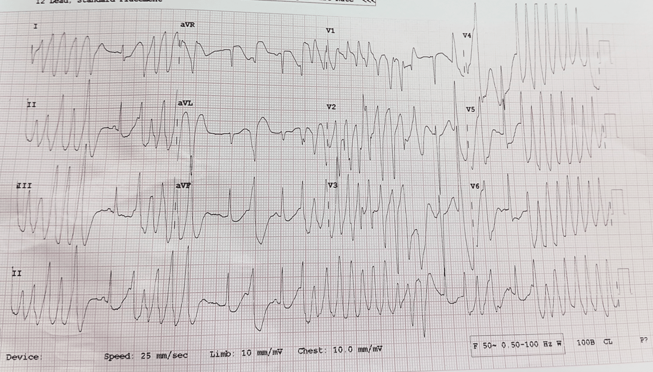 Torsades de Pointes in Respiratory Failure & GTCS: A Case Report ...