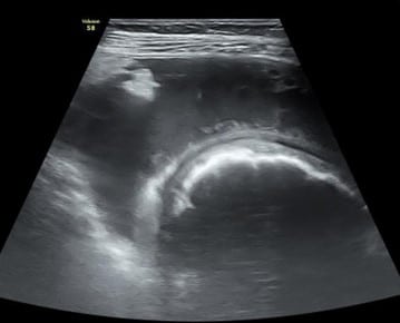 USG to the Rescue: Solving a Case of Atypical Appendicitis - medtigo ...