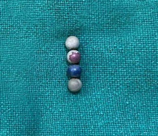 Risks of Magnet Ingestion: GI Complications in Children - medtigo Journal