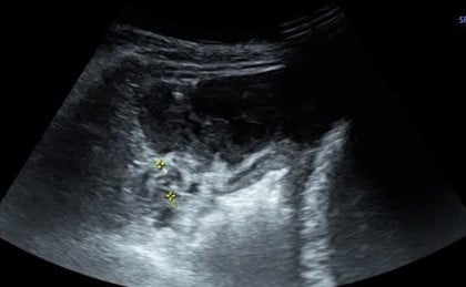 USG to the Rescue: Solving a Case of Atypical Appendicitis - medtigo ...