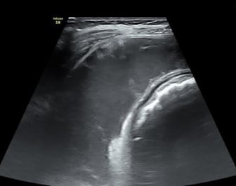 USG to the Rescue: Solving a Case of Atypical Appendicitis - medtigo ...