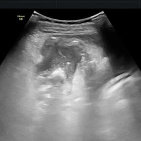 USG to the Rescue: Solving a Case of Atypical Appendicitis - medtigo ...