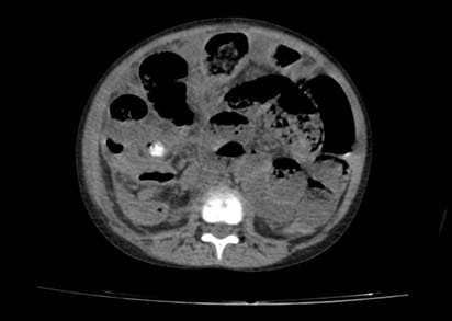 USG to the Rescue: Solving a Case of Atypical Appendicitis - medtigo ...