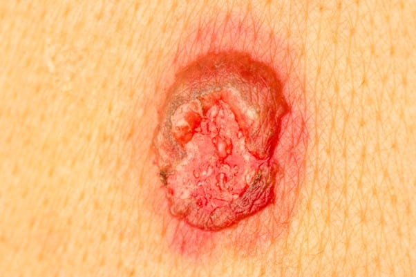 Wound Care in Chronic Ulcers: A Case of Sepsis Management - medtigo Journal