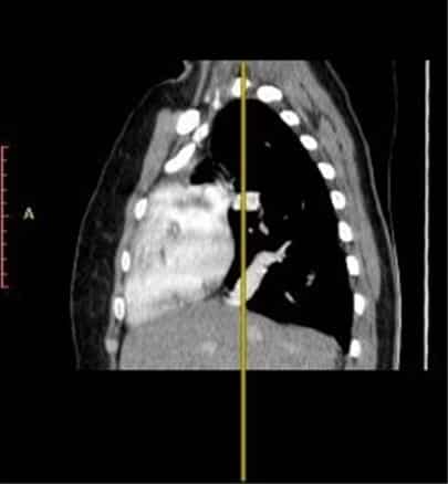 Scimitar Syndrome Misdiagnosed: Lessons from a Rare Case - medtigo Journal