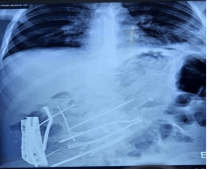 Gastrointestinal Bezoars: Rare Causes of Perforation Peritonitis ...