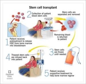 Role of the Nurse in Bone Marrow Transplantation - medtigo Journal