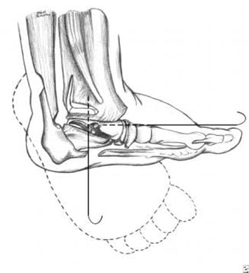 Ponseti Method For Idiopathic Congenital Clubfoot: A Study from ...
