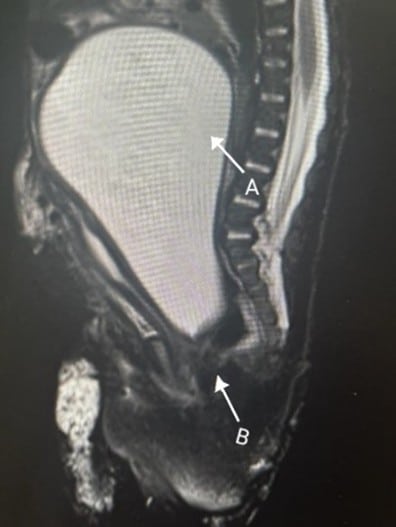 Antenatal Hydrometrocolpos with Transverse Vaginal Septum and ...
