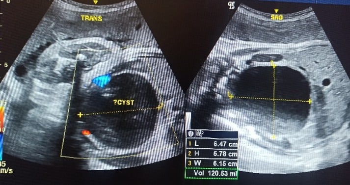 Antenatal Hydrometrocolpos with Transverse Vaginal Septum and ...