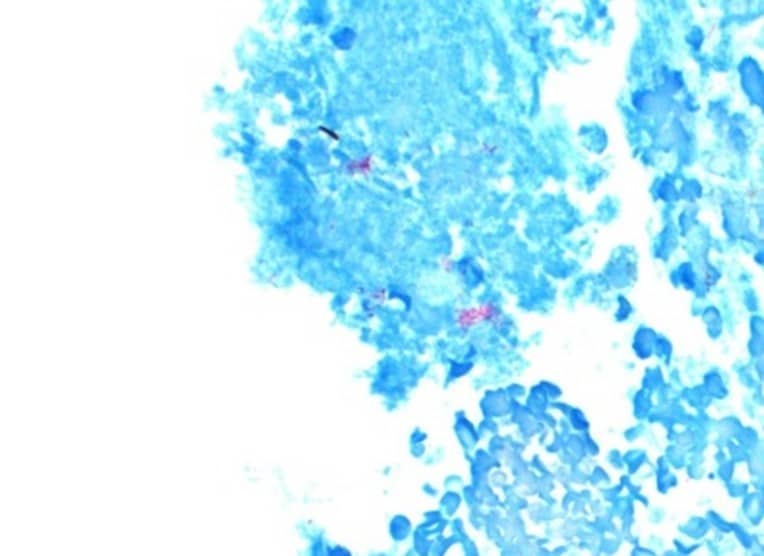 Mycobacterium Avium Complex Infection Presentation with Rare Fungal ...