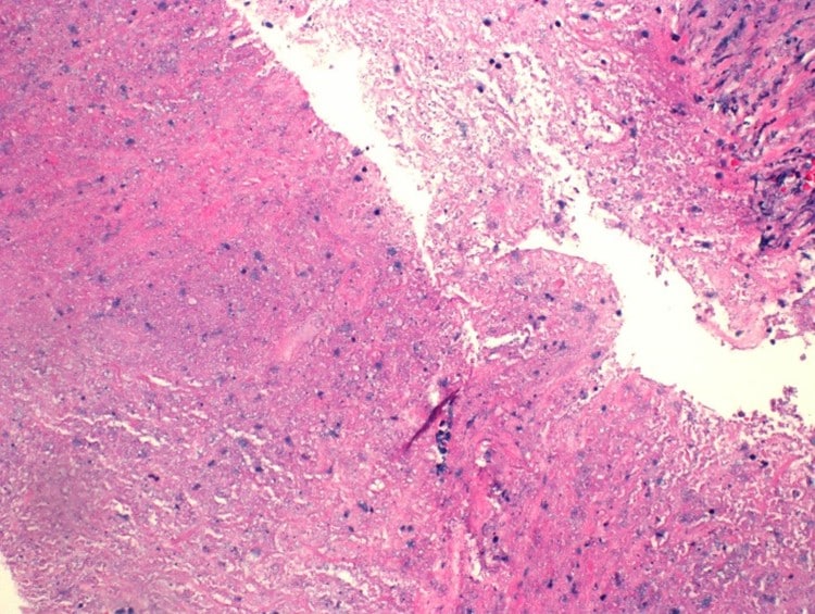 Mycobacterium Avium Complex Infection Presentation with Rare Fungal ...