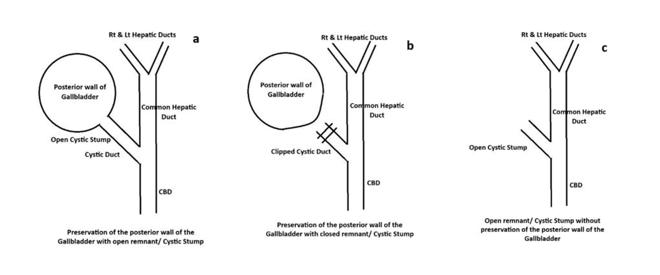 A Study of Combined Laparoscopic-Endoscopic Approach for Complex ...