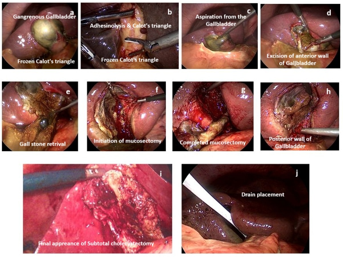A Study of Combined Laparoscopic-Endoscopic Approach for Complex ...