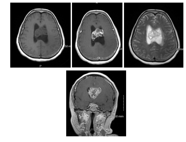 Lateral Intraventricular Glioblastoma Presentation with Increased ...