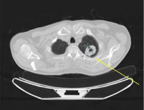 Mycobacterium Avium Complex Infection Presentation with Rare Fungal ...