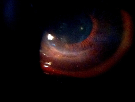 Spontaneous Corneal Perforation in Pellucid Marginal Degeneration: A ...