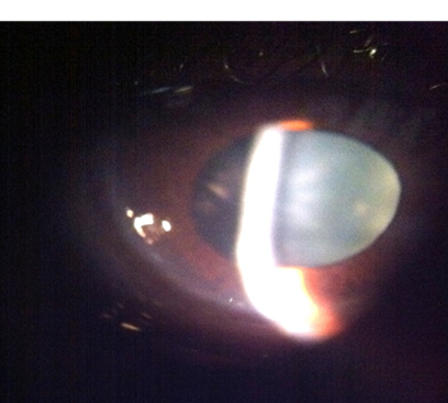 Spontaneous Corneal Perforation in Pellucid Marginal Degeneration: A ...