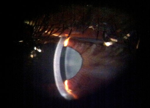 Spontaneous Corneal Perforation in Pellucid Marginal Degeneration: A ...