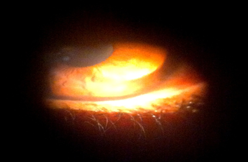 Spontaneous Corneal Perforation in Pellucid Marginal Degeneration: A ...