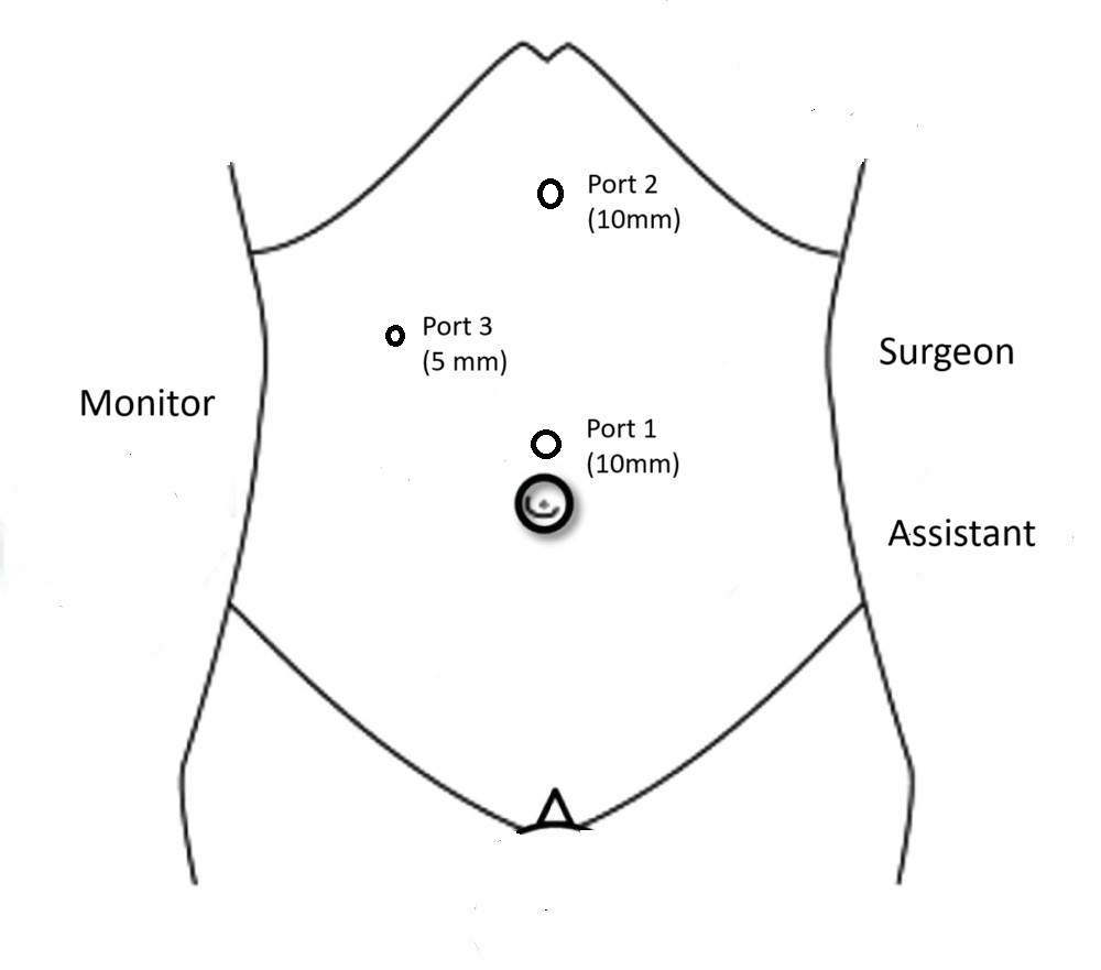 A Study of Laparoscopic (Simple or Complex) Cholecystectomy with or ...