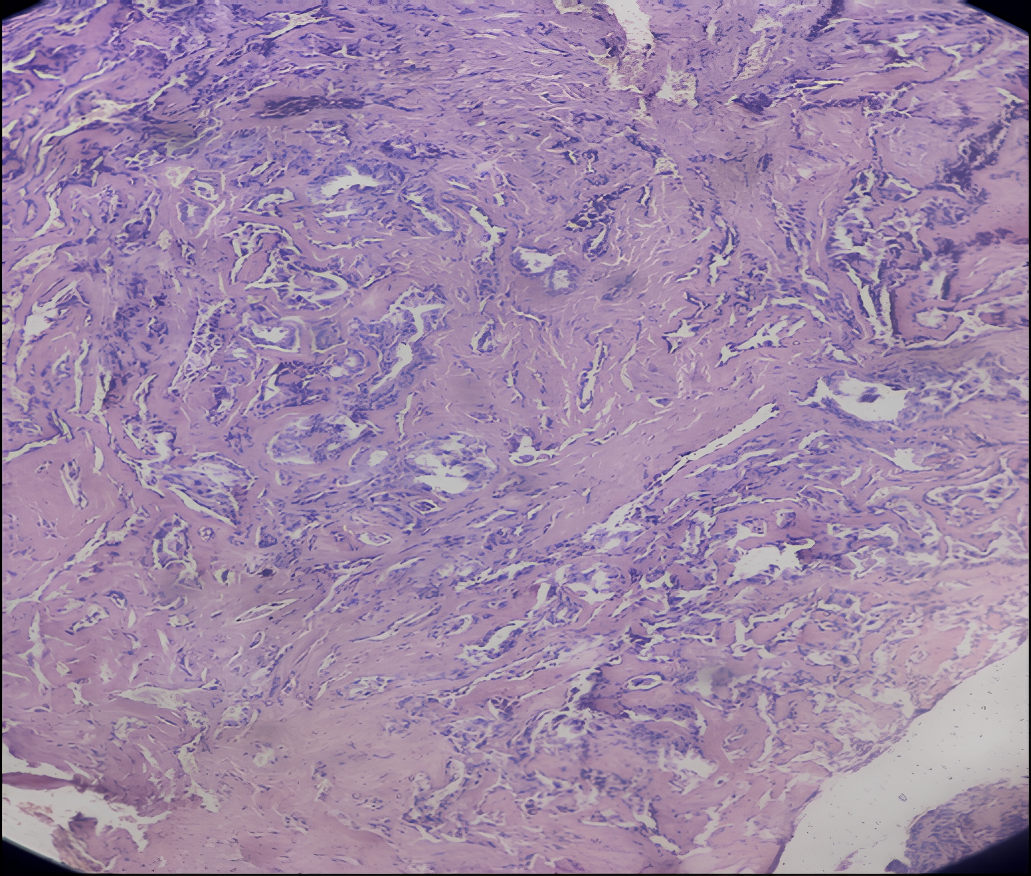 A Rare Case of Ceruminous Adenocarcinoma of External Auditory Canal ...