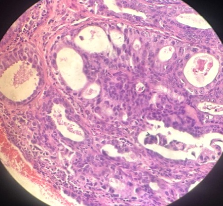 A Rare Case of Ceruminous Adenocarcinoma of External Auditory Canal ...