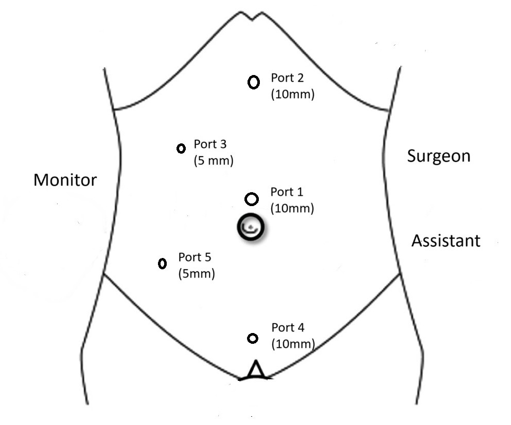 A Study of Laparoscopic (Simple or Complex) Cholecystectomy with or ...