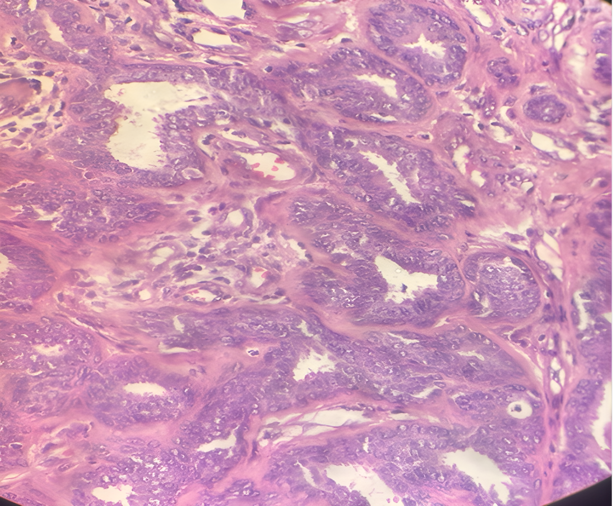 A Rare Case of Ceruminous Adenocarcinoma of External Auditory Canal ...