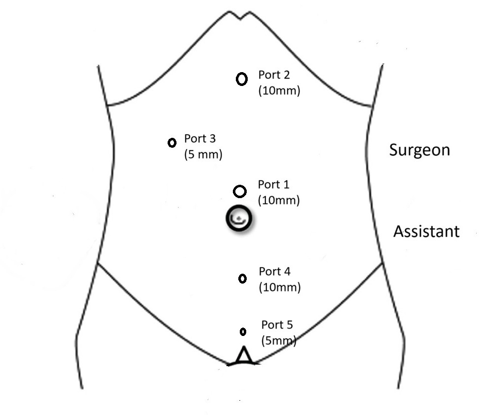 A Study of Laparoscopic (Simple or Complex) Cholecystectomy with or ...
