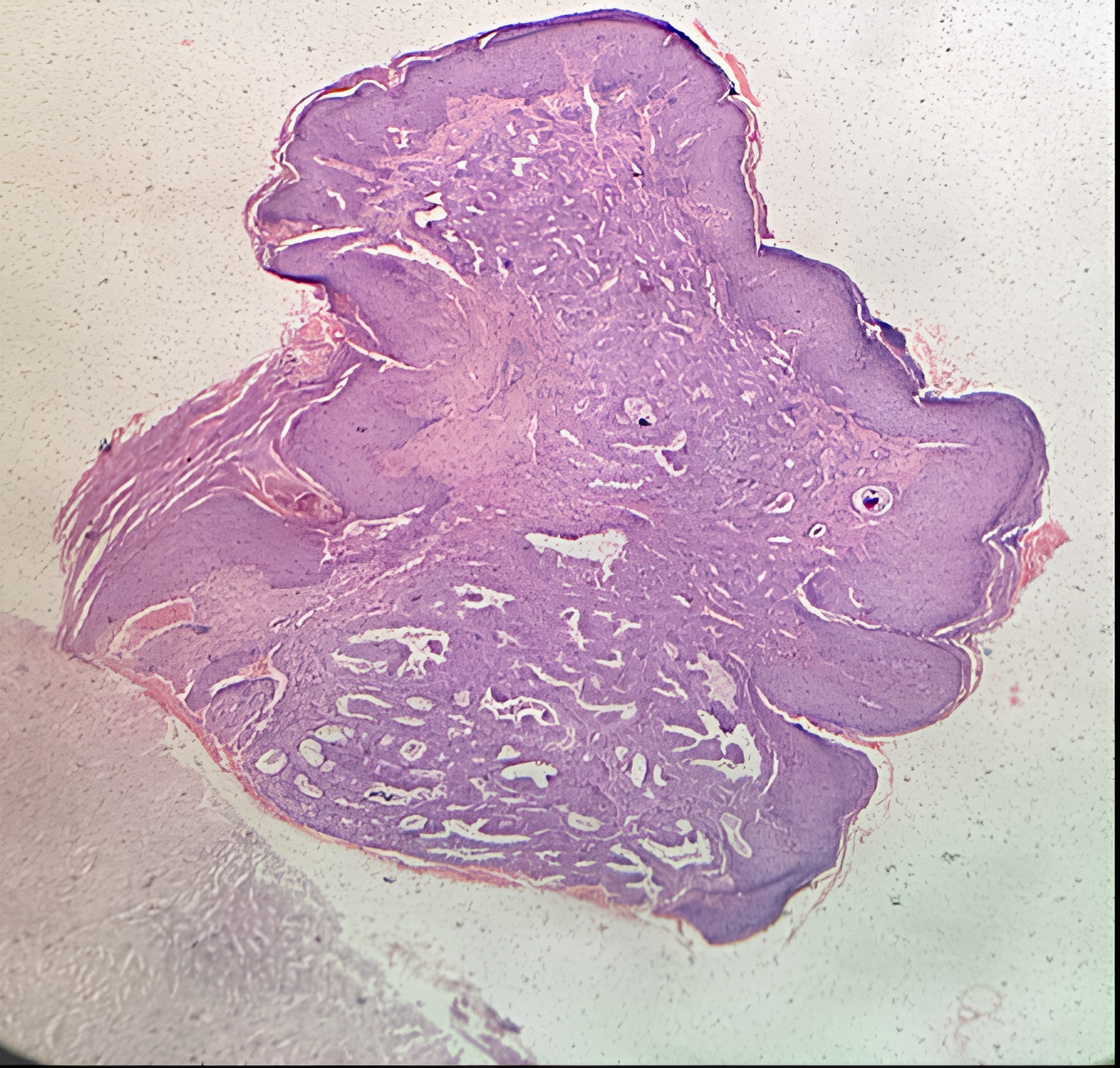A Rare Case of Ceruminous Adenocarcinoma of External Auditory Canal ...