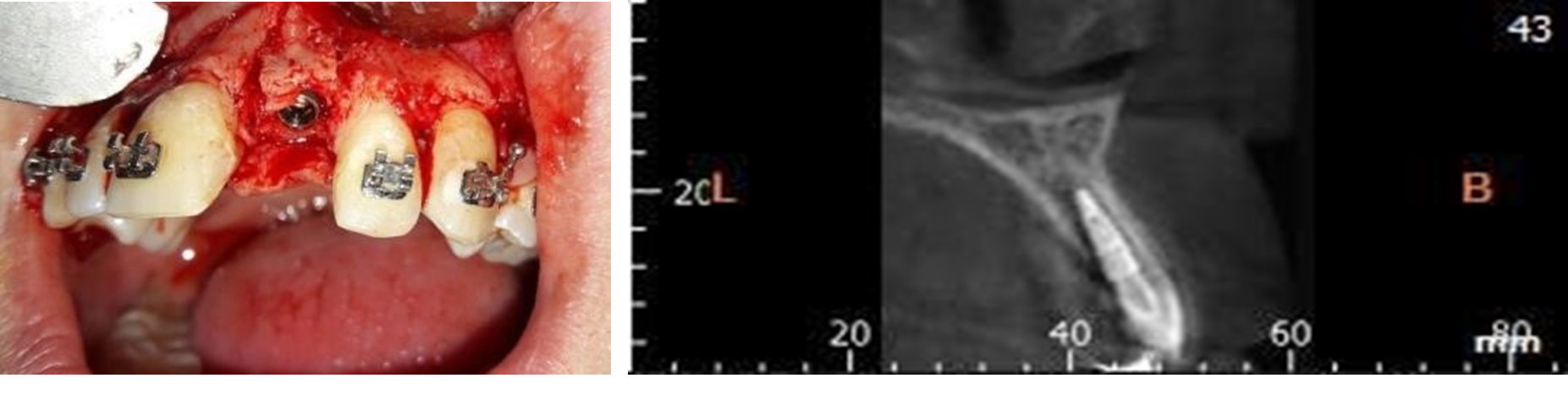Alveolar Split Procedure: Advancing Precision in Dental Surgery ...