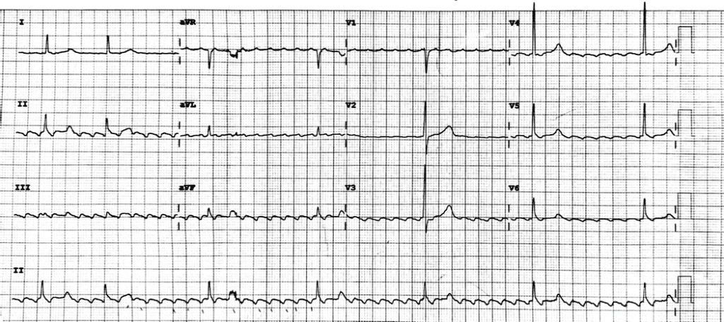 Atrial Flutter With Variable High Degree Av Block An Atypical Case In An Elderly Patient