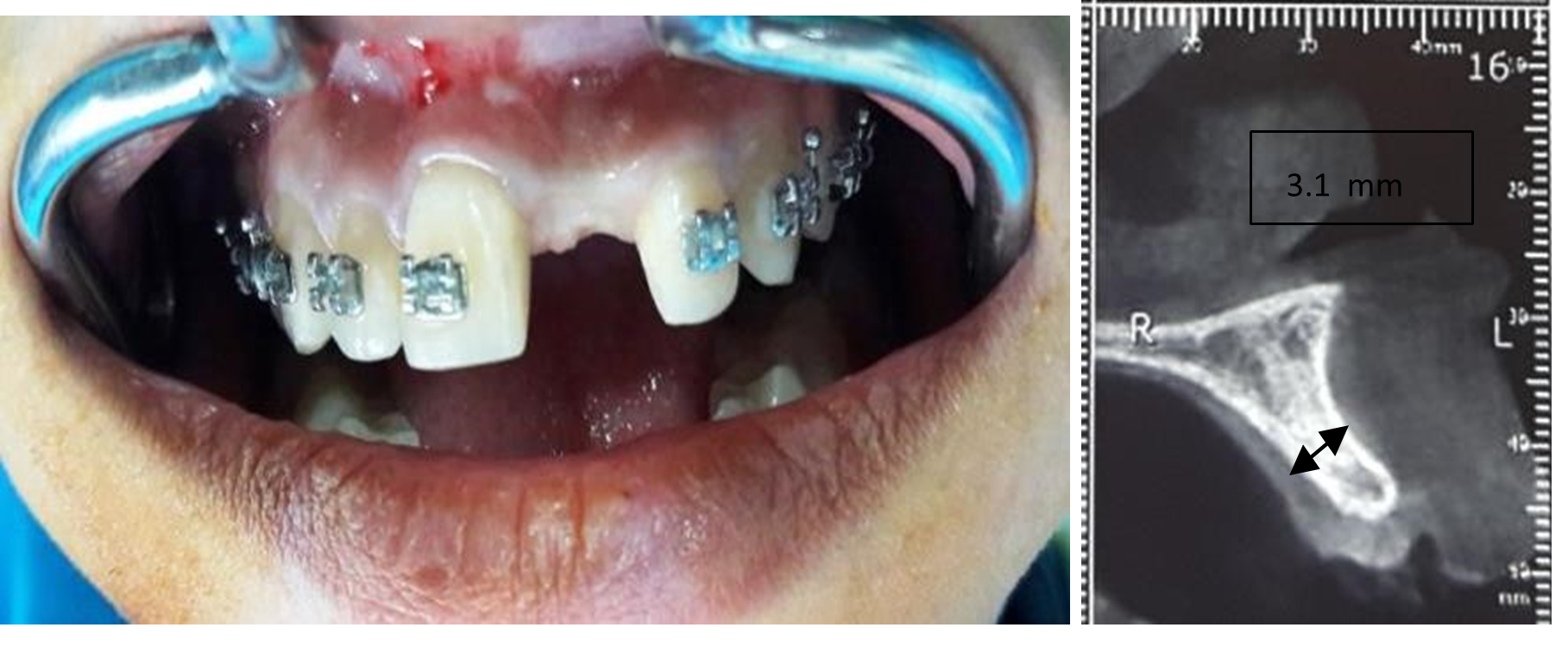 Alveolar Split Procedure: Advancing Precision in Dental Surgery ...