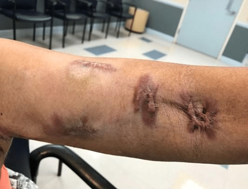 Eruptive Keloids in a Patient on Dialysis: A Case of Suspected ...