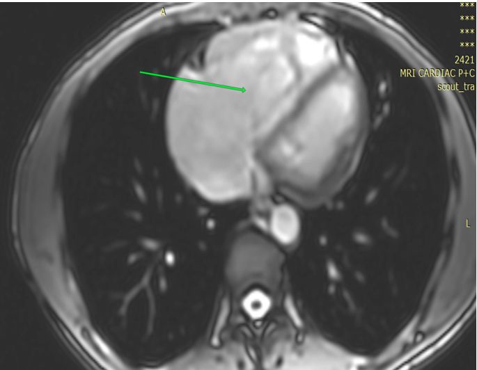 A Case of Arrhythmogenic Right Ventricular Cardiomyopathy with ...
