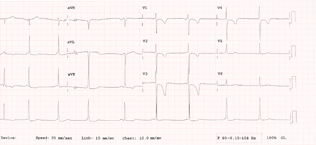 A Case of Arrhythmogenic Right Ventricular Cardiomyopathy with ...